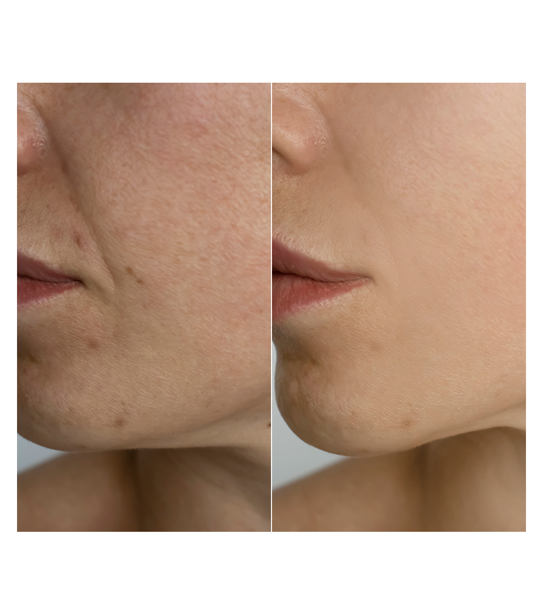 Q Switch Laser Treatment for Pigmentation at Best Price | VLCC
